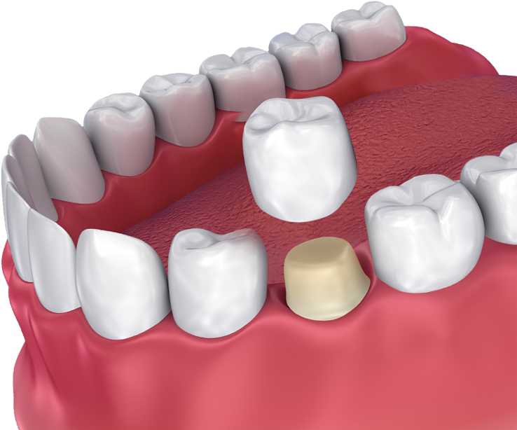 Congratulations! The PNG Image Has Been Downloaded (Dental Crown ...