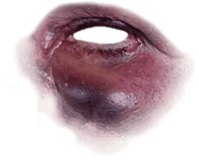 Congratulations! The PNG Image Has Been Downloaded (Black Eye - Bruise ...