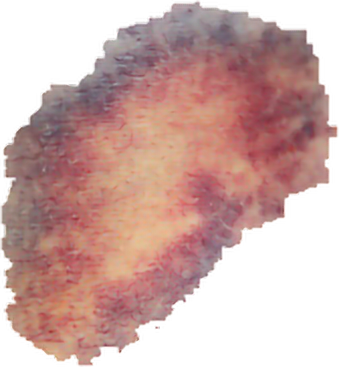 Congratulations! The PNG Image Has Been Downloaded (Bruise Transparent ...