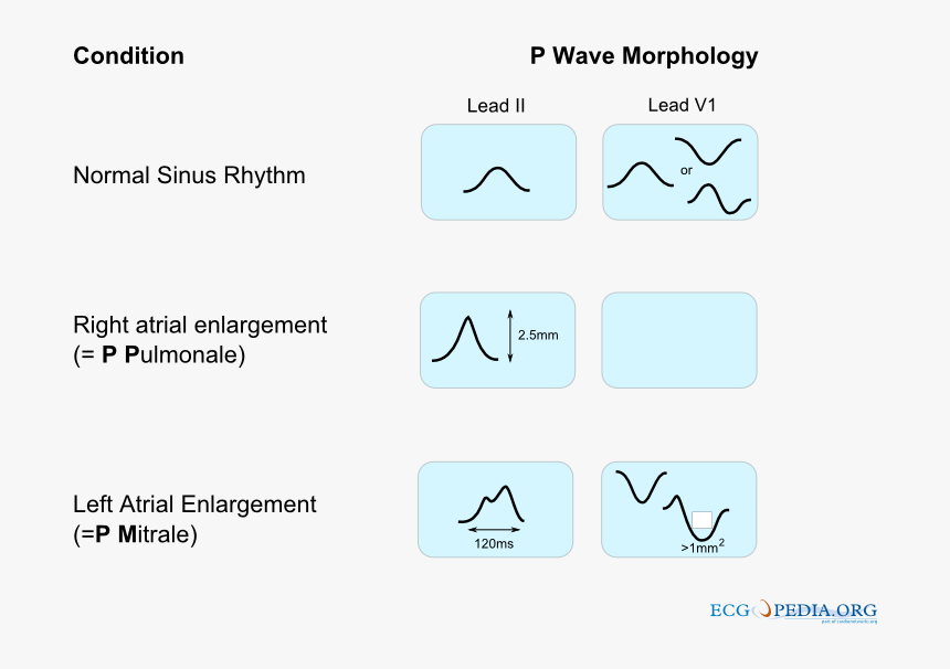 Biatrial Enlargement • LITFL • ECG Library Basics, 56% OFF
