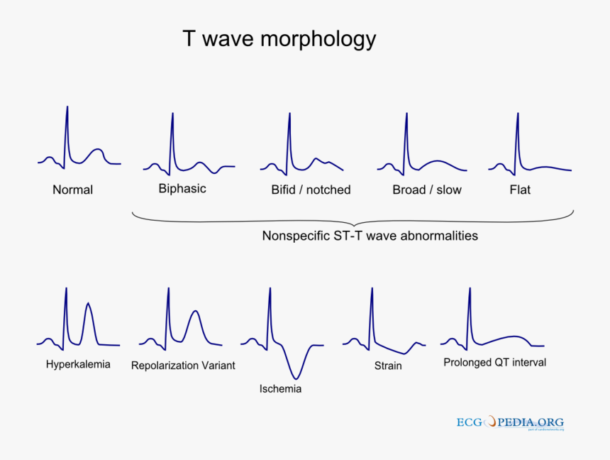 De-t Wave Morphology - T Wave Morphology, HD Png Download , Transparent ...
