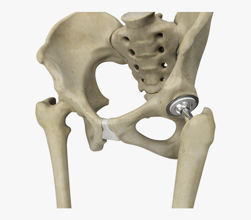 Artificial Hip Joint - Total Hip Replacement Png, Transparent Png ...