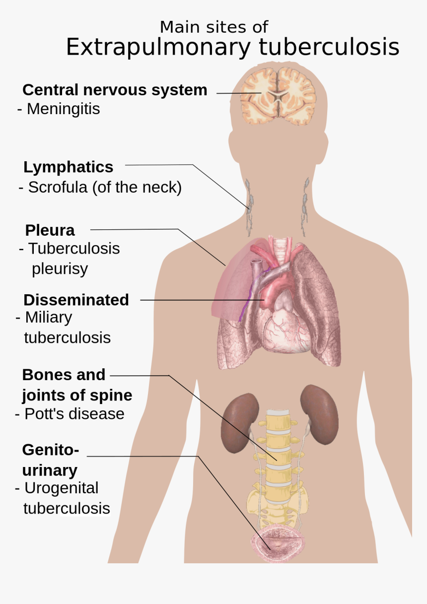 Extrapulmonary Tuberculosis Symptoms - Symptoms Of Tuberculosis, HD Png Download , Transparent ...