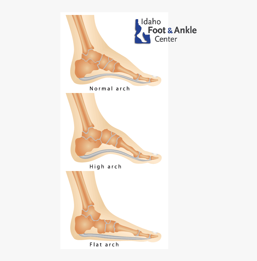 Flat Feet & Other Foot Deformities - Fallen Foot Arch, HD Png Download ...