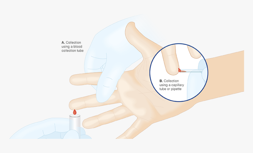 Collecting A Finger Capillary Blood Sample Via Blood - Blood Collection ...