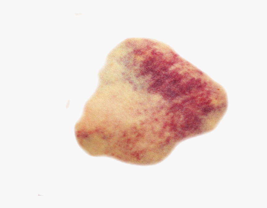 Transparent Bruise, HD Png Download , Transparent Png Image - PNGitem