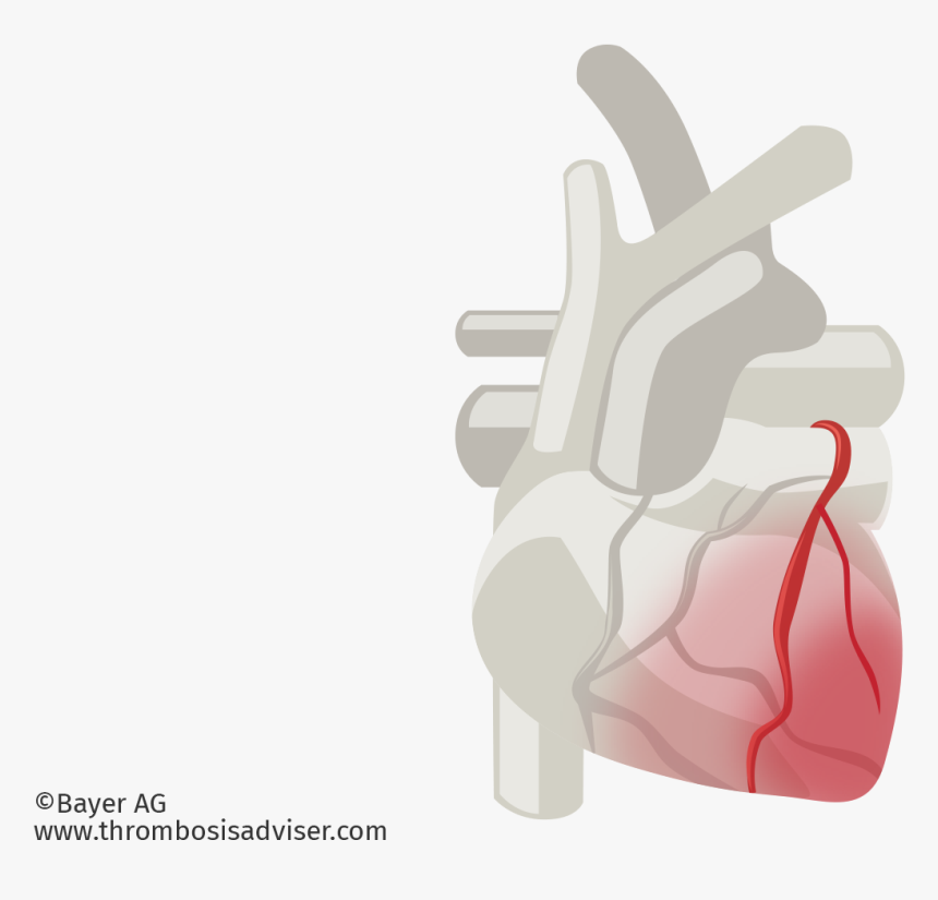 Cardiac Muscle Damage In Acs - Illustration, HD Png Download ...