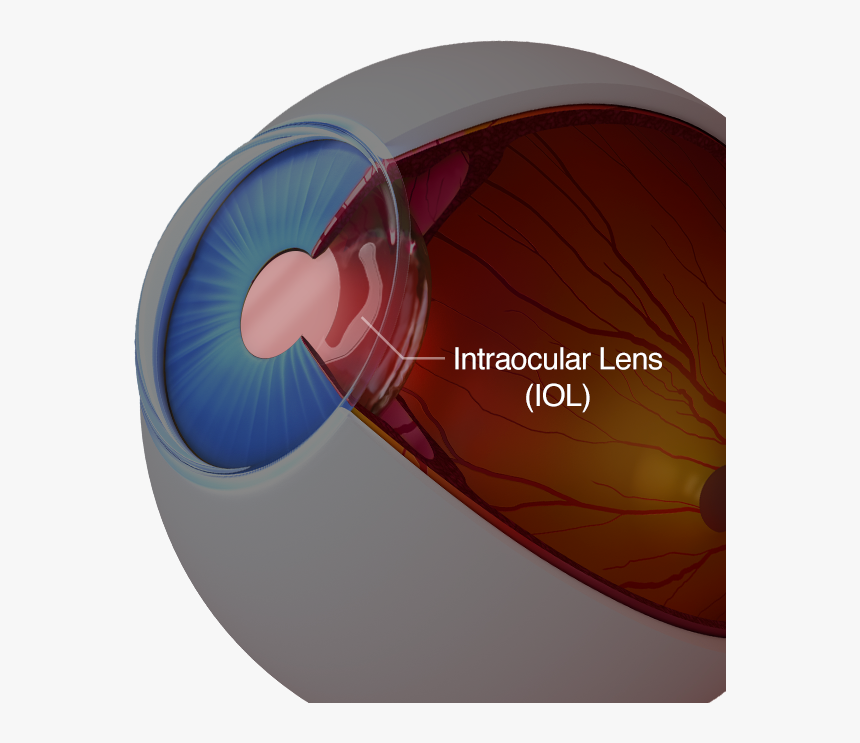 A Diagram Of An Eye With An Intraocular Lens - Intraocular Lens, HD Png ...