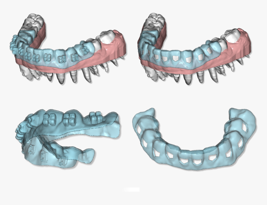 3d Printer Clear Aligner Models, HD Png Download , Transparent Png ...
