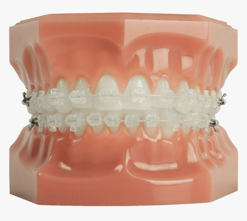 Braces Png, Transparent Png , Transparent Png Image - PNGitem