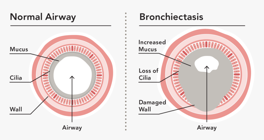 Bronchiectasis Loss Of Cilia, HD Png Download , Transparent Png Image ...
