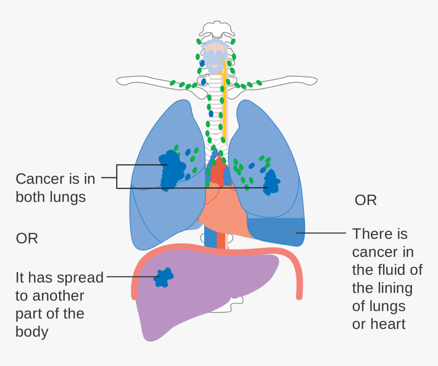 Lung Cancer Cells Diagram