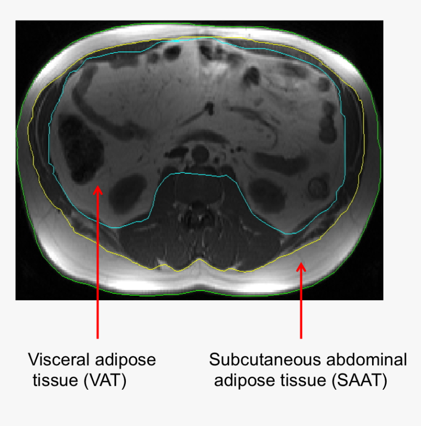 V Fat - Computed Tomography, HD Png Download , Transparent Png Image ...