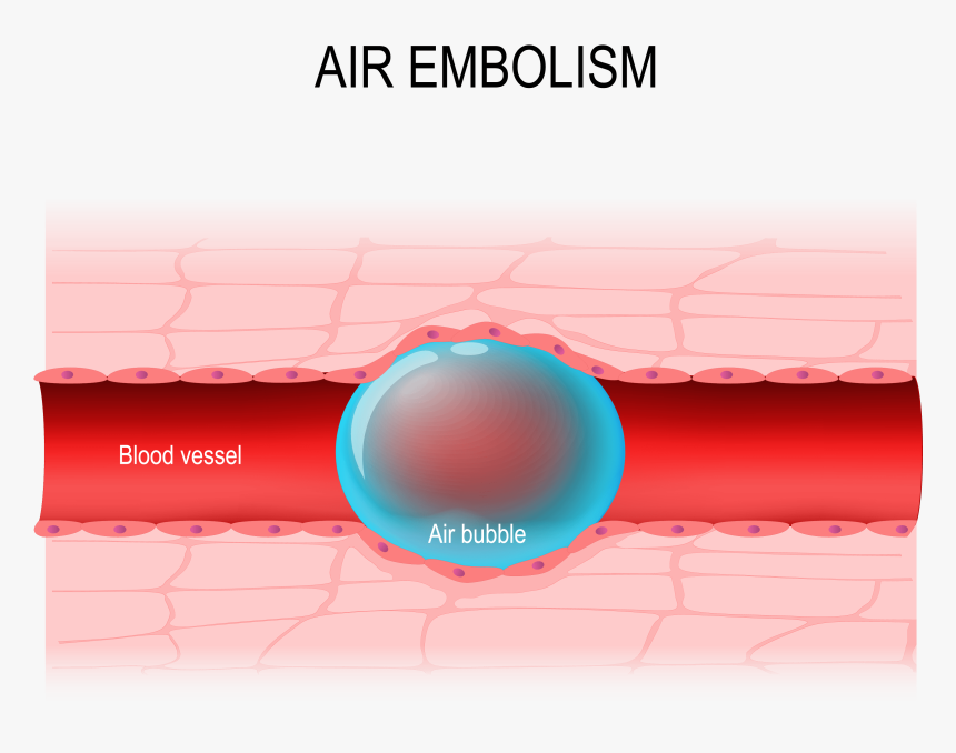 Air Embolism, HD Png Download , Transparent Png Image - PNGitem