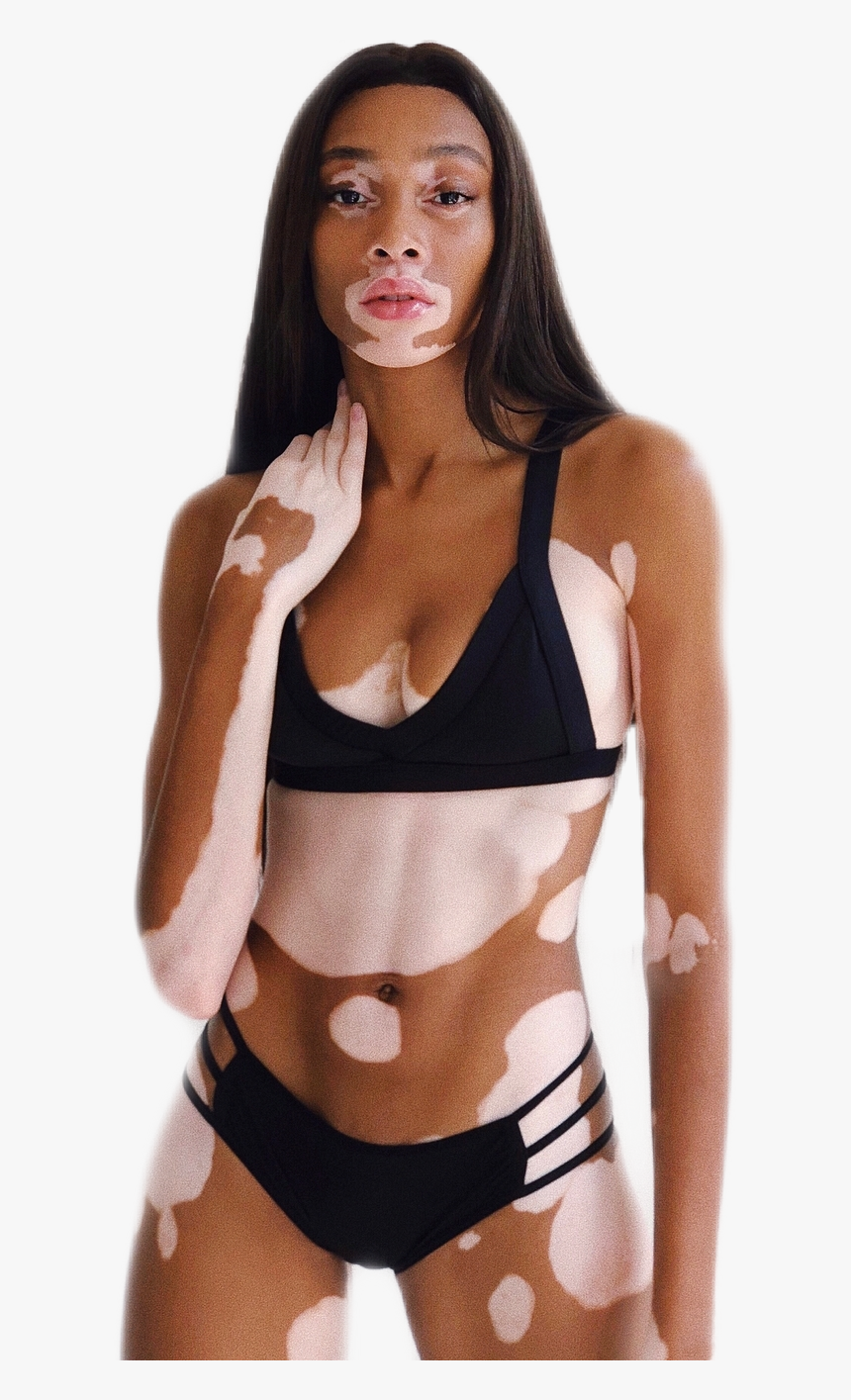 Vitiligo Model