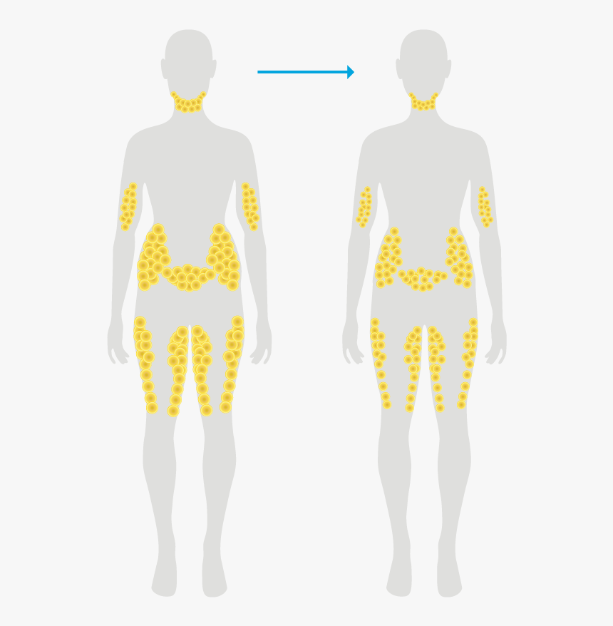 Body Fat Dissolving Injections, HD Png Download , Transparent Png Image ...