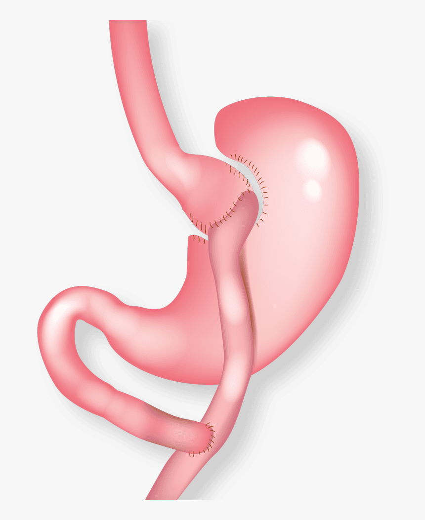 Illustration Of Gastric Bypass - Gastric Bypass Png, Transparent Png ...