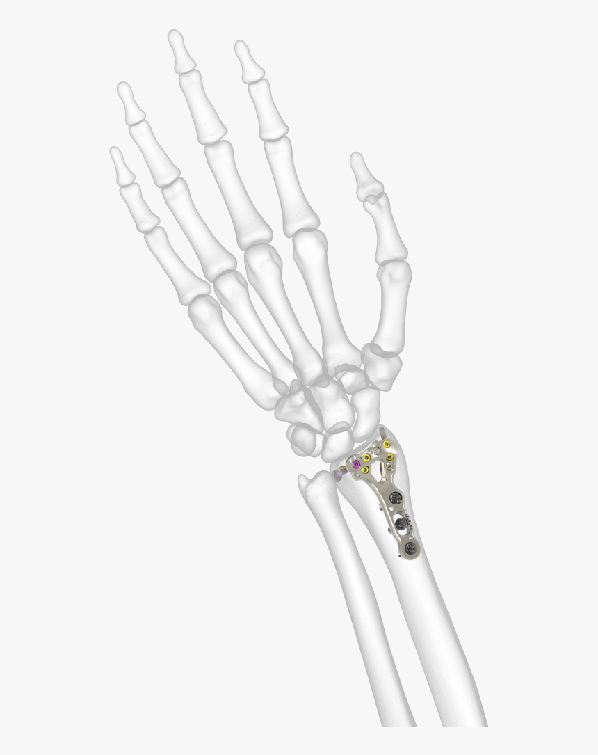 Transparent Bone Radius - Placa Acu Loc 2, HD Png Download ...