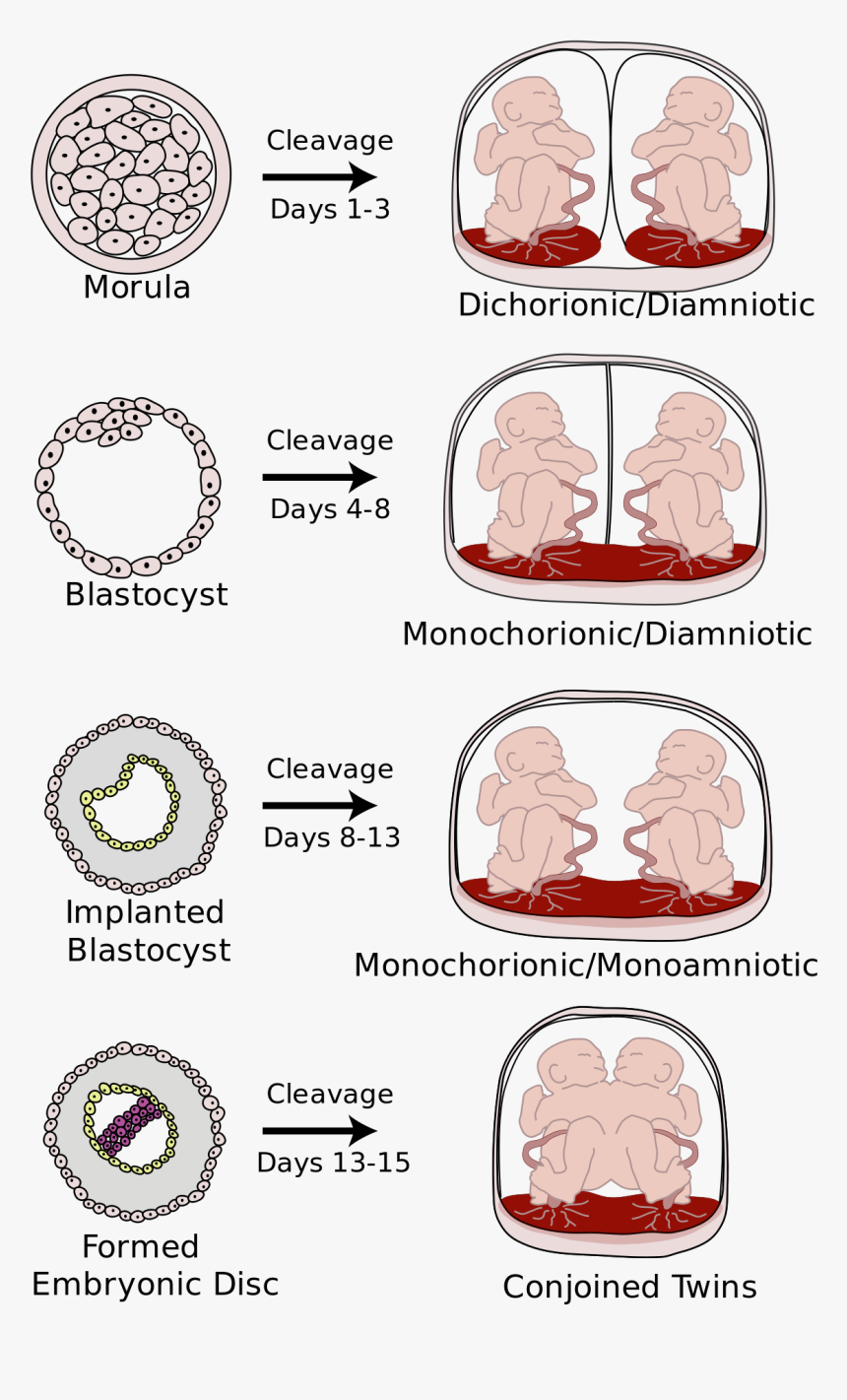 Monochorionic Diamniotic Twins, HD Png Download , Transparent Png Image ...