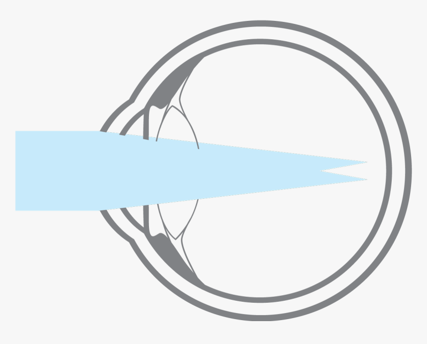 Myopia Vector, HD Png Download , Transparent Png Image - PNGitem