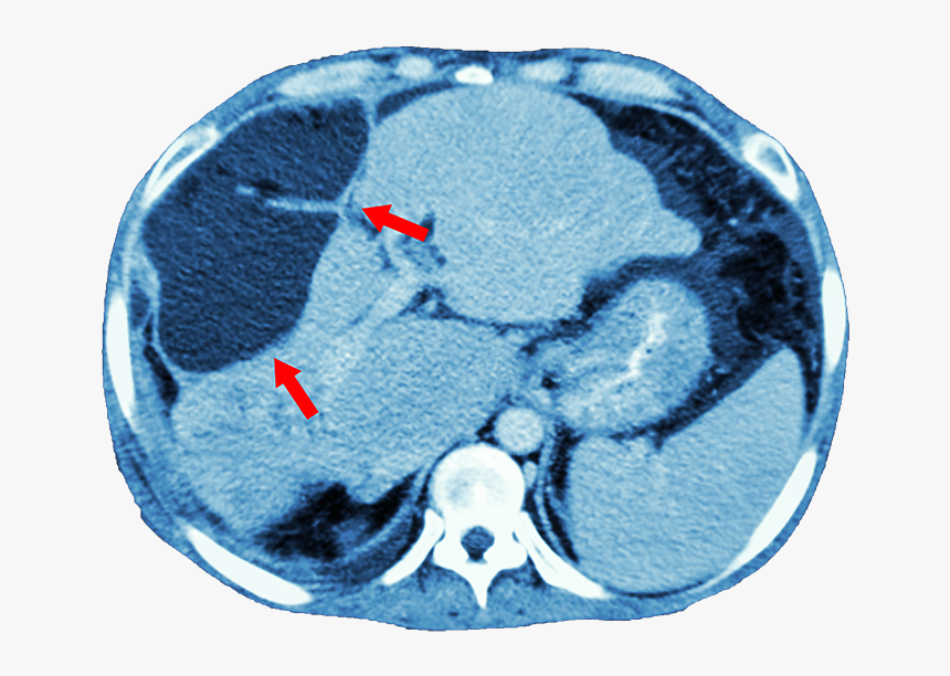 Imaging - Liver Cancer Ct Scan, HD Png Download , Transparent Png Image ...