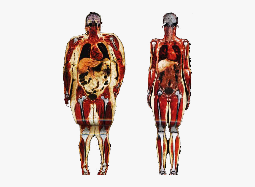 Obesity Human Body Adipose Tissue Anatomy Connective - Fat Person Vs ...