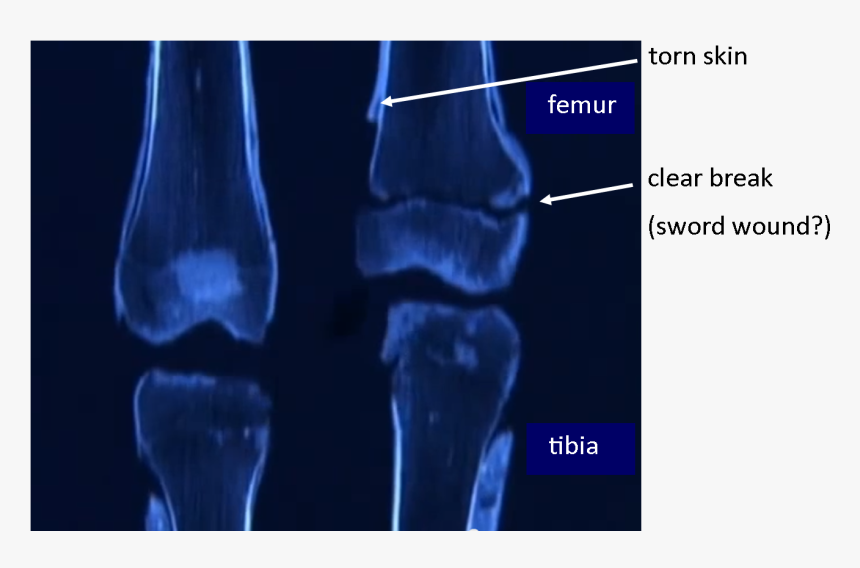 Tut S Leg Bones - Radiography, HD Png Download , Transparent Png Image ...