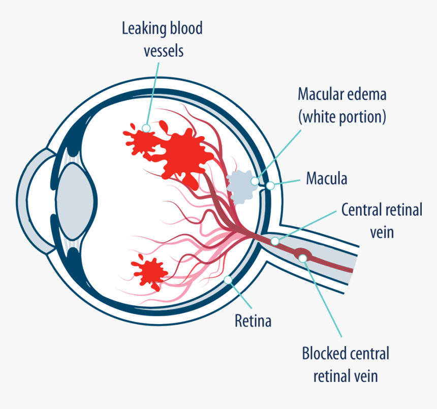Angry Vein Png, Transparent Png , Transparent Png Image - PNGitem