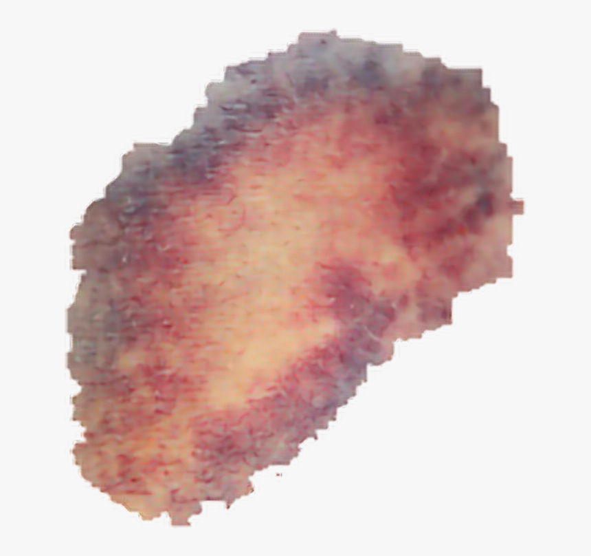 Bruise Transparent Bruises Png , Transparent Cartoons - Transparent ...