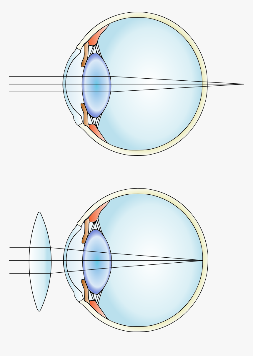 Hypermetropia And Correction - Convex Lens Uses, HD Png Download ...