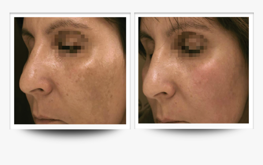 Skin Resufracing - Accent Prime Before And After, HD Png Download ...
