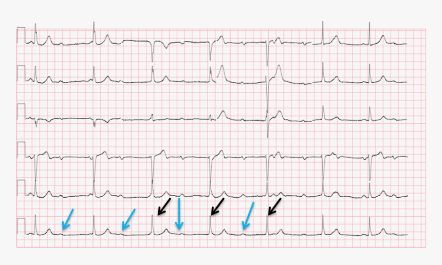 Conduction Ecg - Handwriting, HD Png Download , Transparent Png Image ...