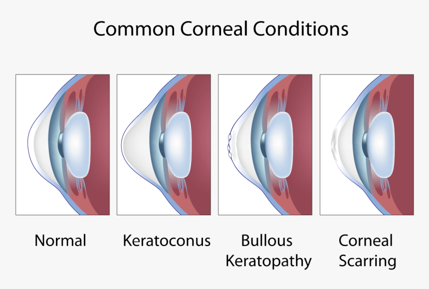 Common Corneal Conditions - Keratoconus And Astigmatism, HD Png ...