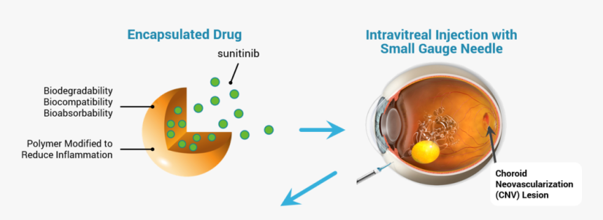 Intravitreal Injection, HD Png Download , Transparent Png Image - PNGitem