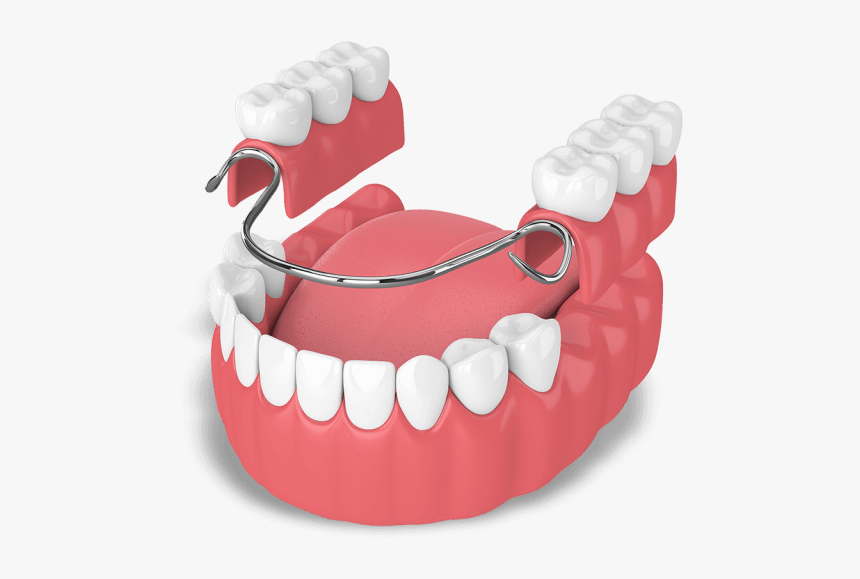 Que Es Una Protesis Dental, HD Png Download , Transparent Png Image ...