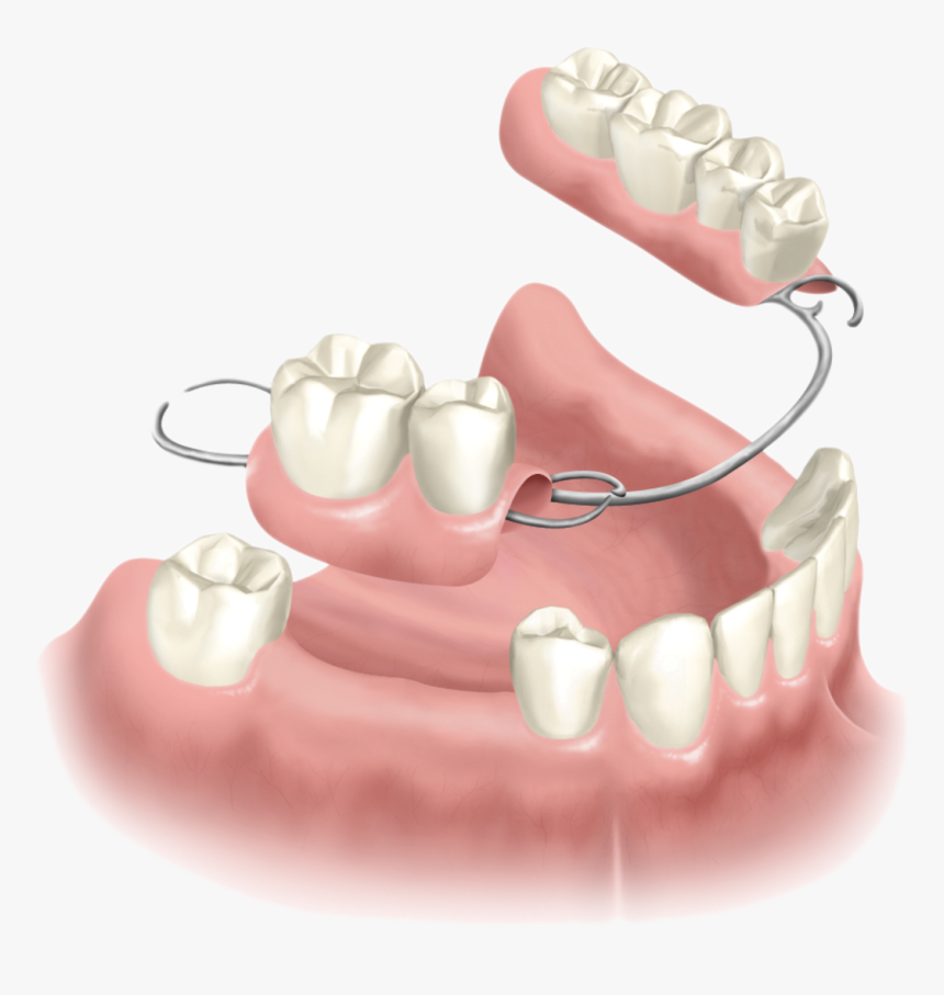 Dental Partial Denture, HD Png Download , Transparent Png Image - PNGitem