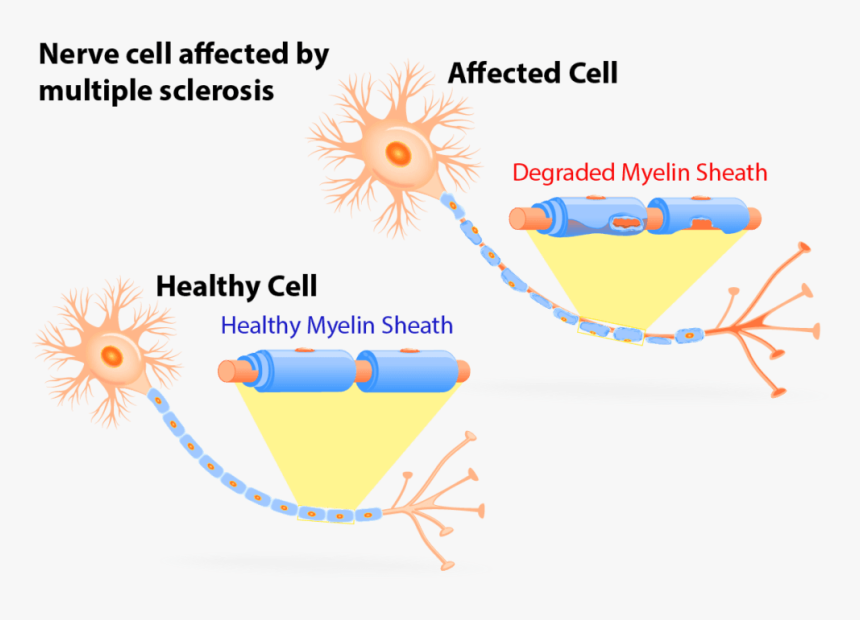 Multiple Sclerosis Nerve Cells, HD Png Download , Transparent Png Image ...