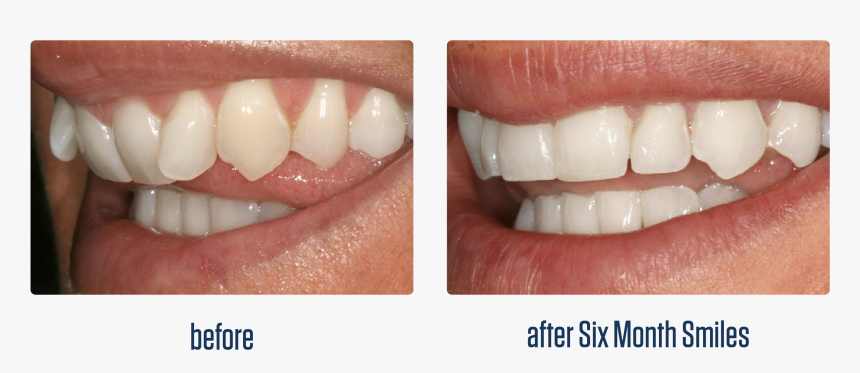 Smile Teeth Png - Front Teeth Go Inwards, Transparent Png , Transparent ...