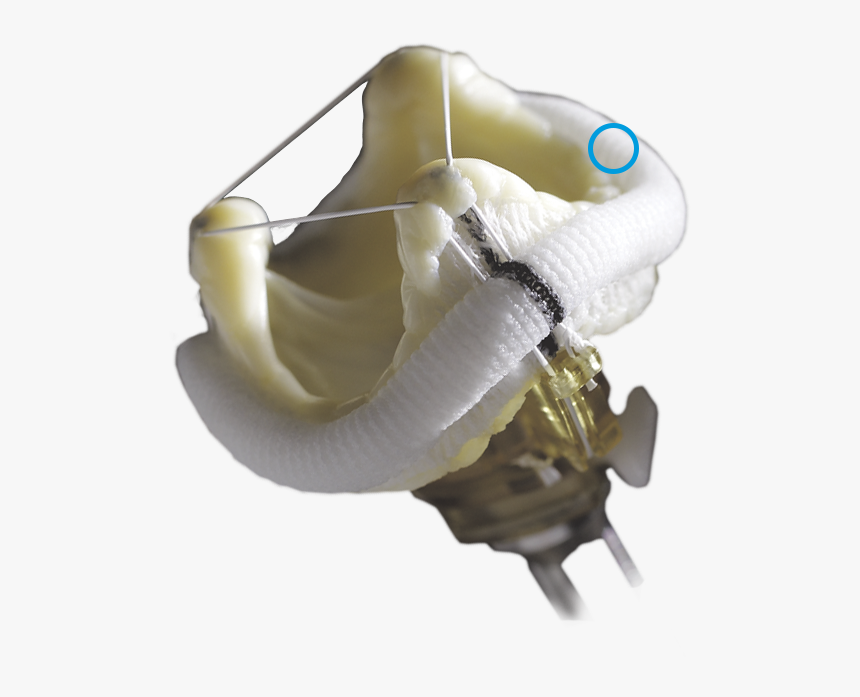 Epic Bioprosthesis Mitral Implantation, HD Png Download , Transparent ...
