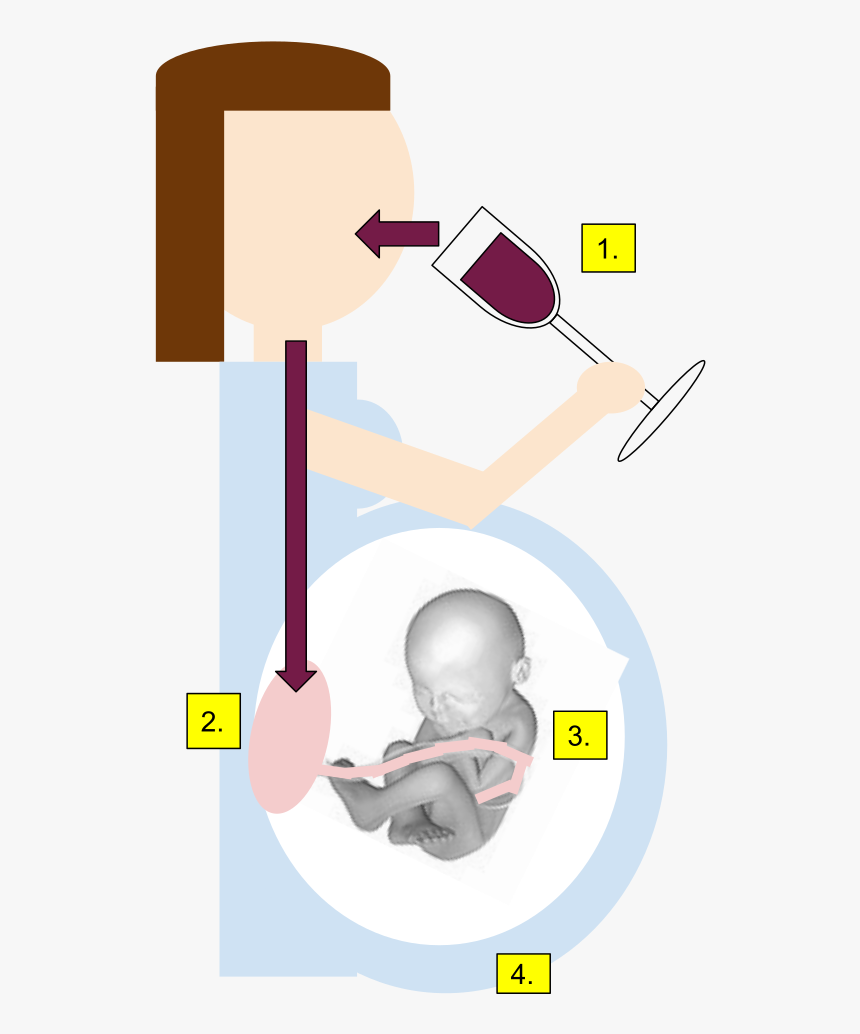 Fetal Alcohol Syndrome Clipart, HD Png Download , Transparent Png Image ...