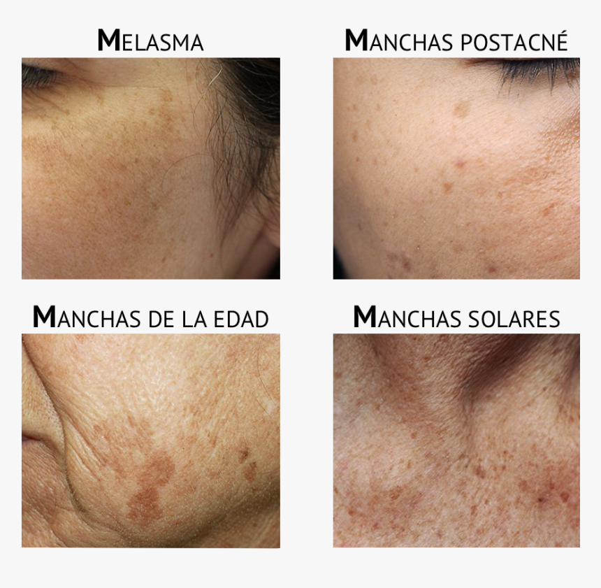 Freckle, HD Png Download , Transparent Png Image - PNGitem