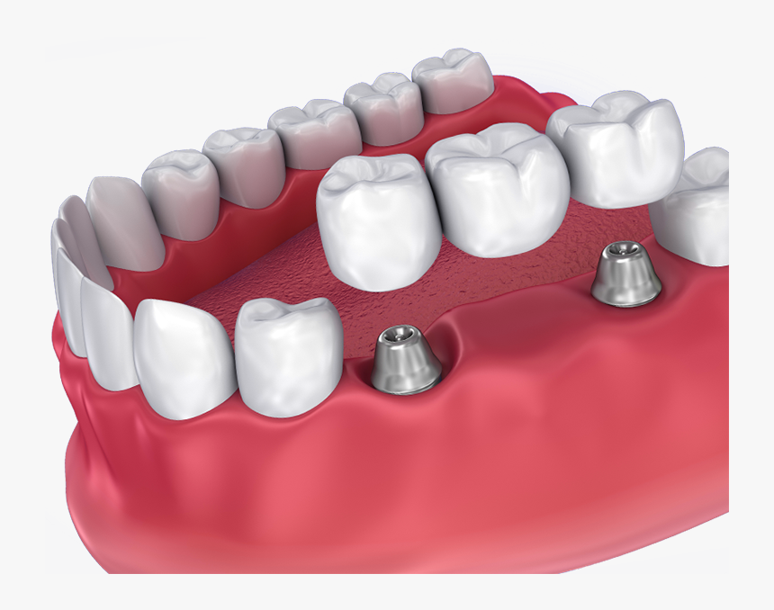 Implant-supported Bridge - Dental Crown, HD Png Download , Transparent ...