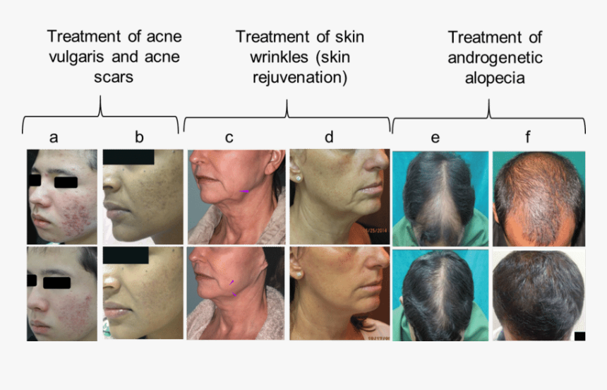 Transparent Wrinkles Png - Collage, Png Download , Transparent Png ...