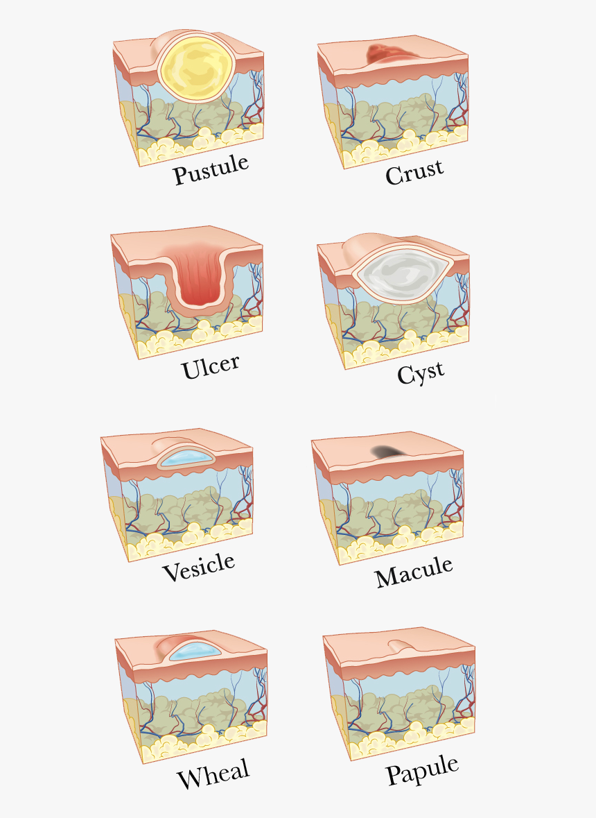 Types Of Skin Lesions, HD Png Download , Transparent Png Image - PNGitem