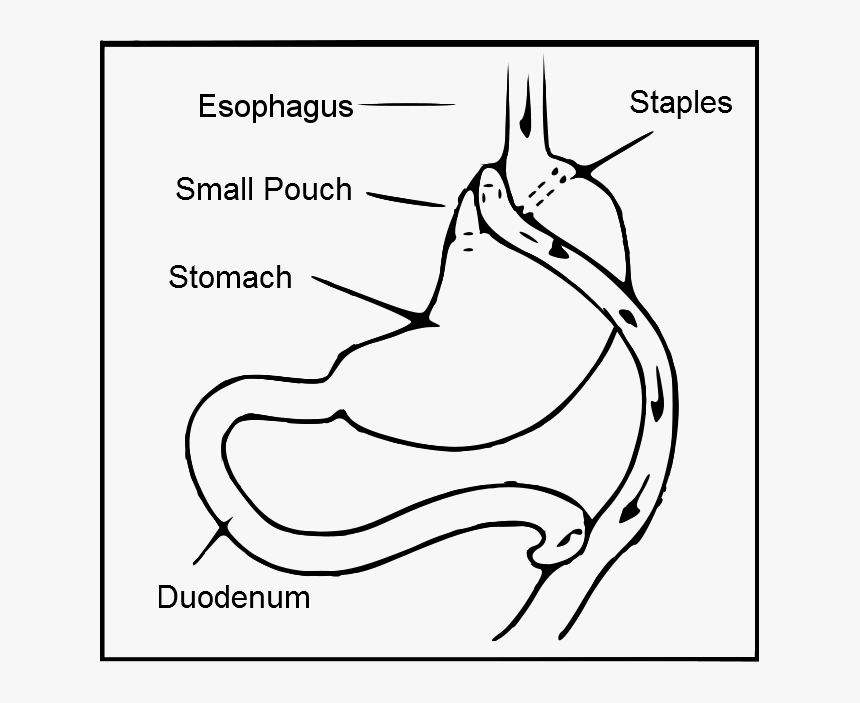 Roux En Y Gastric Bypass - Type Two Diabetes Drawing, HD Png Download ...