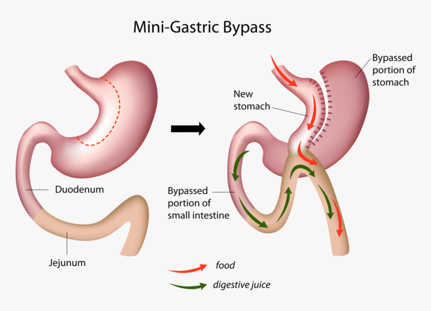 Mini-gastric Bypass, HD Png Download , Transparent Png Image - PNGitem