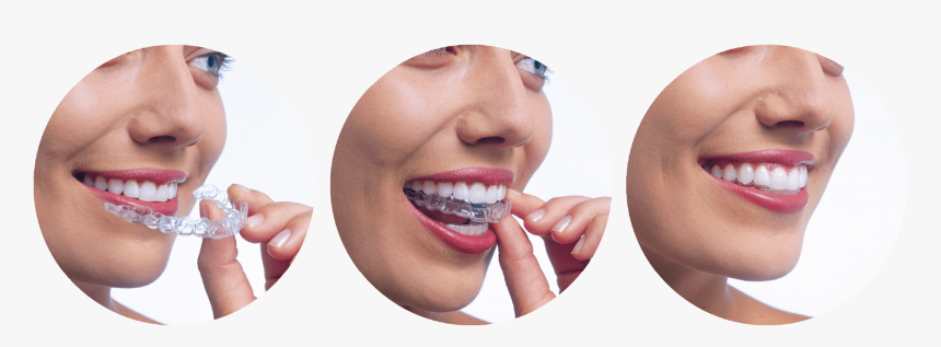 Invisalign - Invisalign Braces In Dubai, HD Png Download , Transparent ...