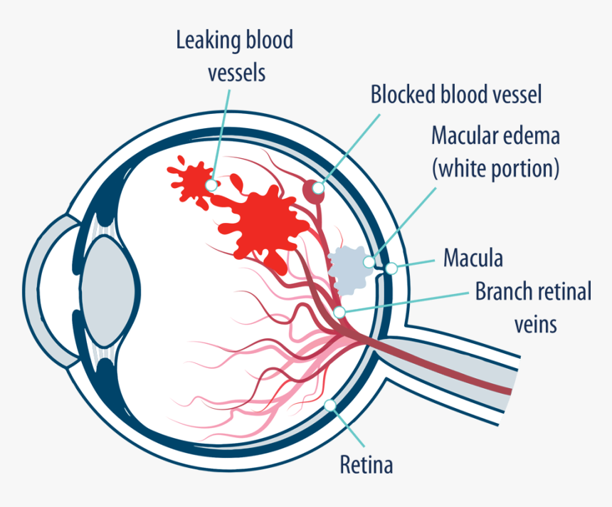 Eye With Macular Edema Following Retinal Vein Occlusion - Edema Macular ...