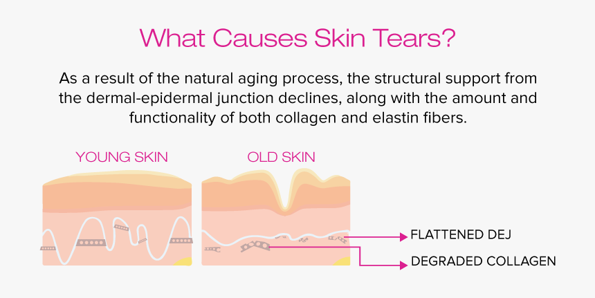 Amige 161110 What Causes Skin Tears - Dermal Epidermal Junction Aging ...