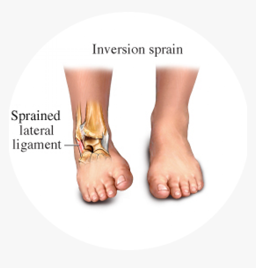 Hhg - Inversion Vs Eversion Ankle Sprain, HD Png Download , Transparent ...
